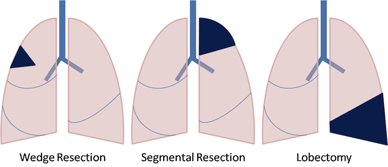 Lung Cancer Surgery | Surgical Resection for Lung Cancer Patients