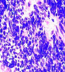 Types of Lung Cancers | Small Cell and Non-Small Cell Lung Cancer